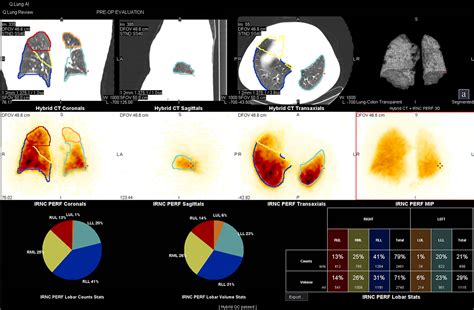 Expanding Lung Cancer Applications With Spectct Ge Healthcare