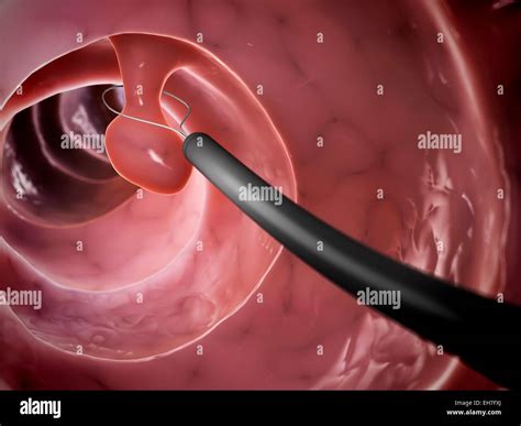 Risks Of Uterine Polyp Removal