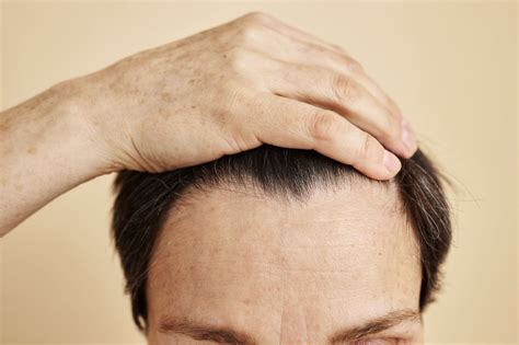 What Is Scalp Reduction Surgery 3 Facts To Transform Your Hairline