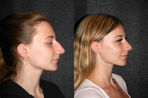 Rhinoplasty Nose Job Artofit