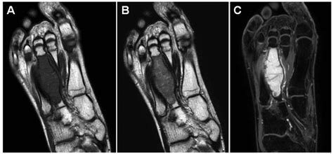 Low Grade Central Osteosarcoma Of The Metatarsal Bone A