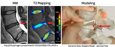 Understanding Herniated Discs And Its Diagnosis El Paso Chiropractor