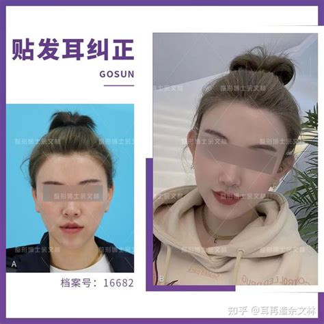 贴发耳看了这么多艺人证件照好像没有耳朵贴面的明星 知乎