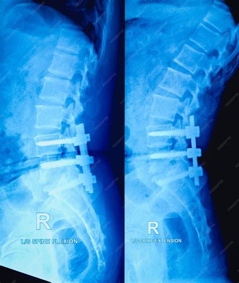 Premium Photo Xray Of Female Lumbosacral Spine Flexion And Extension