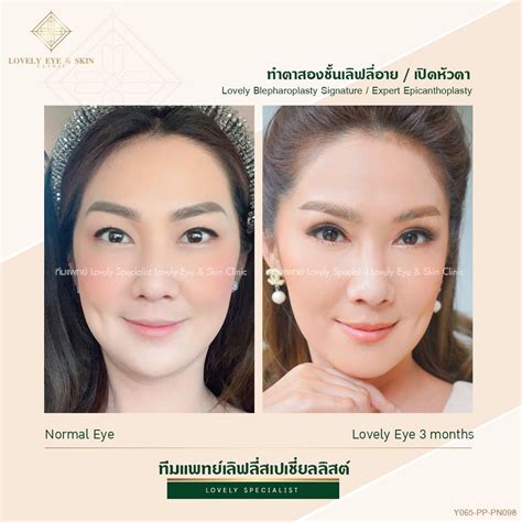 ทำตาสองชั้น เปิดหัวตา ทำตาสองชั้น เปิดหัวตา ถุงใต้ตา โดยหมอรวงข้าว