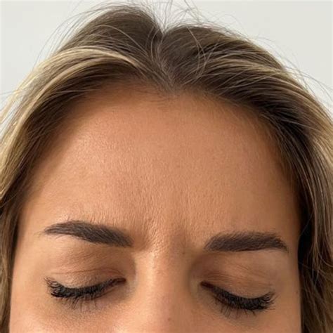 Botulinum Toxin Wrinkle Removal Newu Institute