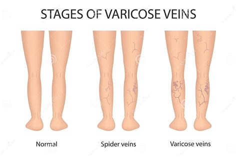 Human Legs Stages Of Vein Disease Varicose Veins Medical