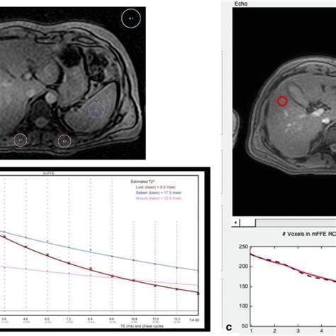 Liver Iron Quantification Using A Sir Method Mrquantif Software Download Scientific Diagram