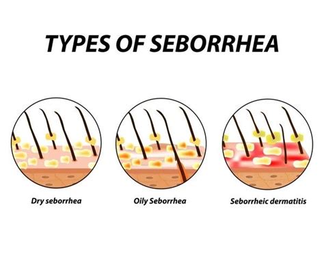 সেবোরিক ডার্মাটাইটিস Seborrheic Dermatitis ও এর ঘরোয়া প্রতিকার