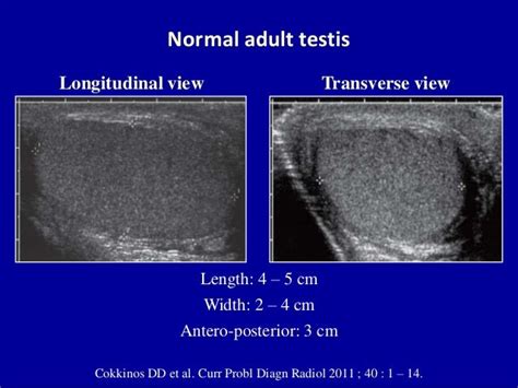 Doppler Ultrasound Of Acute Scrotum