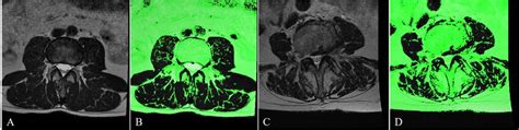Measurement Methodology Of Paraspinal And Psoas Muscle Parameters Pixel