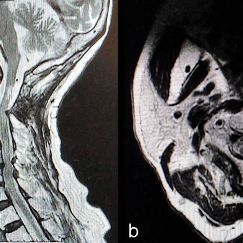 Cervical Spine Ct Scan Showing Expansile Bone Exostosis Arising From