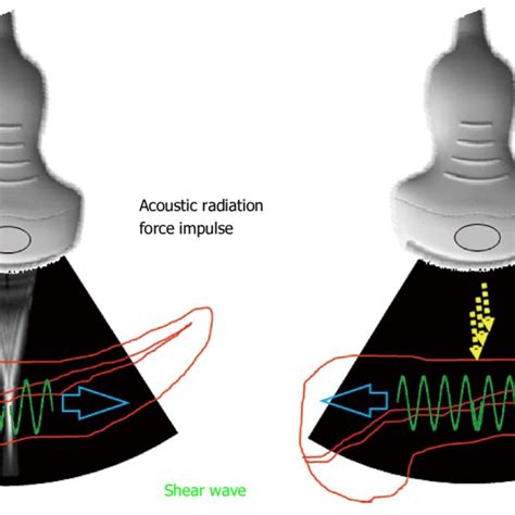 Measurement Principle Of Shear Wave Elastography Acoustic Radiation