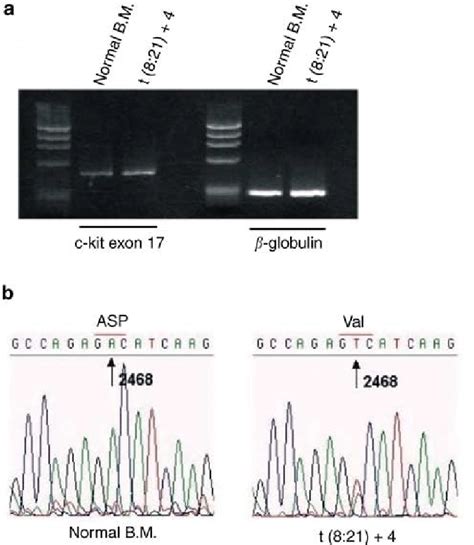 Detection Of C Kit Mutation In Exon 17 In A T 8 21 AML With Trisomy 4