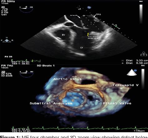 Figure 1 From Windsock Deformity Of Submitral Left Ventricular Aneurysm