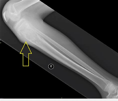 X Ray Shows An Ill Defined Lytic Lesion At The Proximal Third Of The
