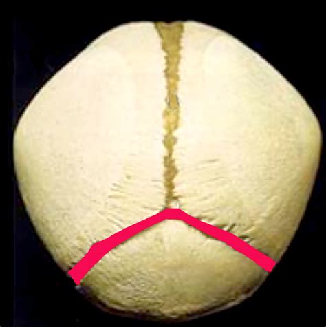 Lambdoid Synostosis