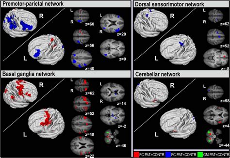 Significant Between Group Differences Of Functional Connectivity Fc