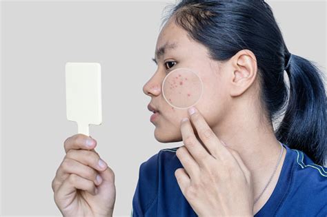 줌 서클에서 여드름 피부를 가진 젊은 여자의 닫기 동그라미가 있는 아시아 여성의 얼굴은 여드름 치료 전후의 피부 문제를 보여