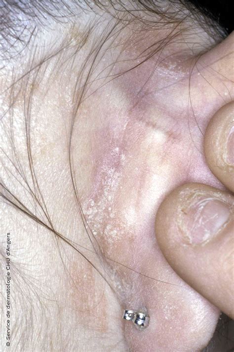 Difference Between Eczema And Psoriasis In Ears At Nathan Oneill Blog