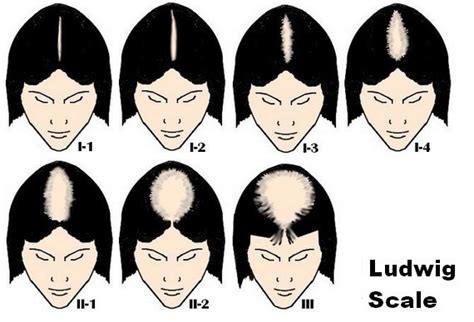 Ludwig Hair Loss Scale 2025 Hairstyles Ideas