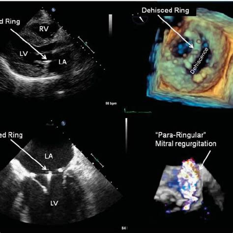 Arrow Pointing To The Amplatzer Pda Closure Device Used To Close Download Scientific Diagram