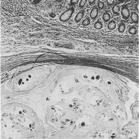 Appendix With Fibrosis And Calcification In Wall In Presence Ofpurulent