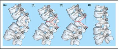 Figure 5 From Closing Opening Wedge Osteotomy For The Treatment Of