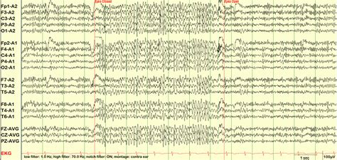 Posterior Dominant Rhythm
