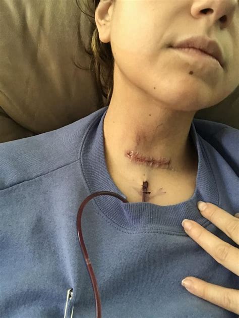 Thyroidectomy Check… Whats Next R Gravesdisease