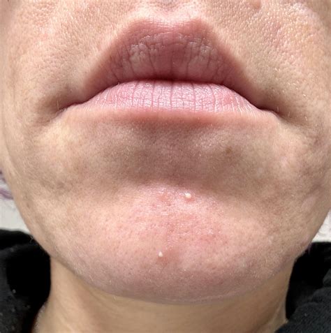 Bfs Facial Hair Causing Acne Rskincareaddiction