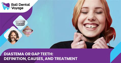Diastema Meaning Causes And Gap Teeth Treatment