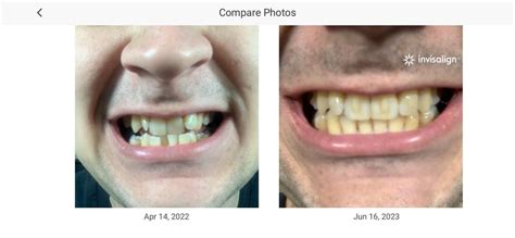 Last Tray R Invisalign