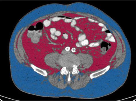 Abdominal Adipose Tissue Segmentation Representative Ct Scan Obtained