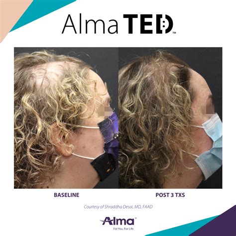 Ted Hair Restoration Fig Medical Spa
