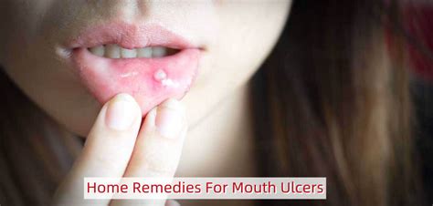 Remedies For Blister On Tongue