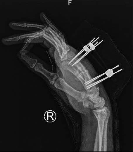 38 Metacarpal Fracture Open Reduction And Internal Fixation Orif