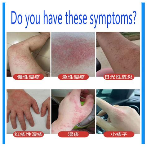 Skin Antibacterial Herbal Cream Bacteriostatic And Antipruritic Eczema