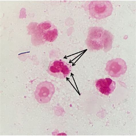 Vaginal Gram Stain Upon Admission Small Gram Negative Coccobacilli