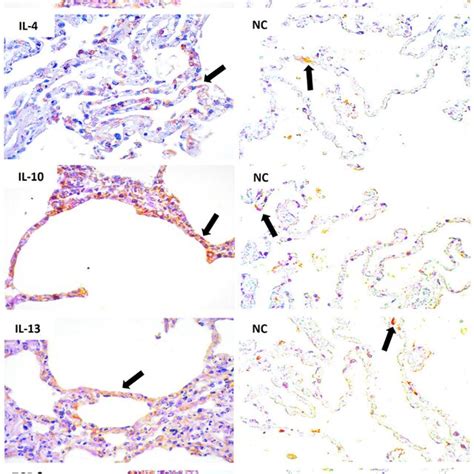 Positive Immunostaining Pattern For Ifn γ Il 4 Il 10 Il 13 And