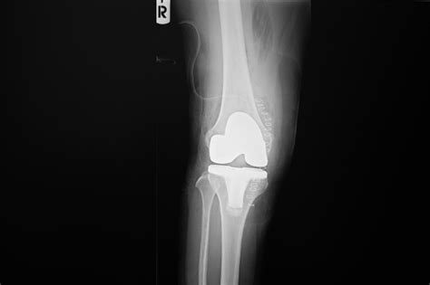 全膝關節置換 Lanteroposterior 膝關節的 X 線圖像 照片檔及更多 X光片 照片 X光片 人工膝關節 人體構造