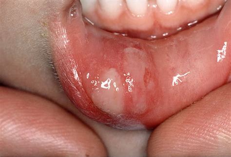 Mouth Ulcers Are Common Lesions · Center For Specialized Dentistry