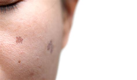 ΚΗΛΙΔΕΣ ΠΡΟΣΩΠΟΥ ΣΩΜΑΤΟΣ ΔΕΡΜΑΤΟΣ Derma Laser And Υγεία Χρήστος
