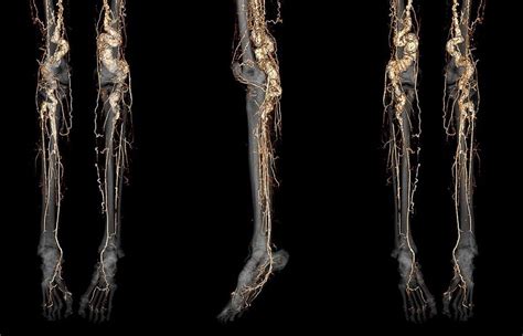 Nih Trial Finds Potential Of Etidronate In Slowing Acdc Progression