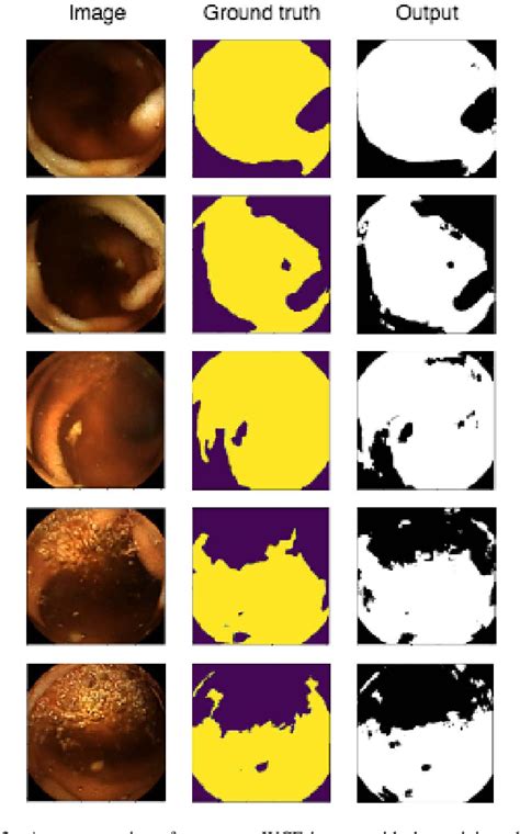 Figure 3 From Bleeding Segmentation Based On A Bleeding Feature