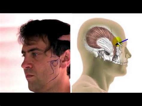 Temporalis Trigger Points Are Often Associated With Migraine Migraine