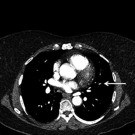 Lower Prevalence Of Subsegmental Pulmonary Embolism After Application Of The Years Diagnostic