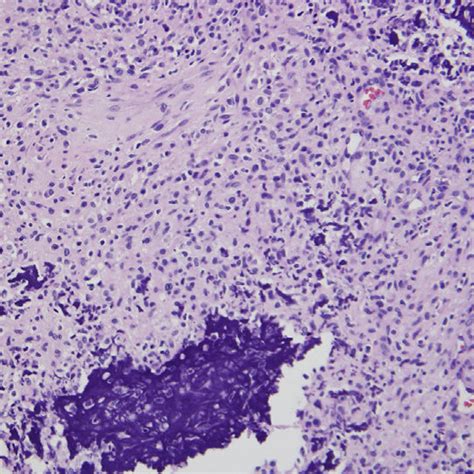 Areas Of Calcifications With Admixture Of The Epithelial And Spindle