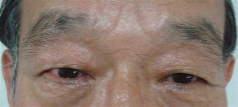 Malignant Pilomatricoma In The Upper Eyelid Bmj Case Reports