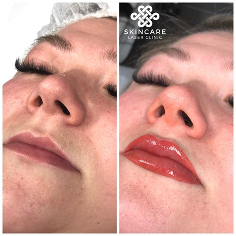 Lip Tattooing Tattoo Lips Permanent Makeup Cosmetic Tattoo Victoria